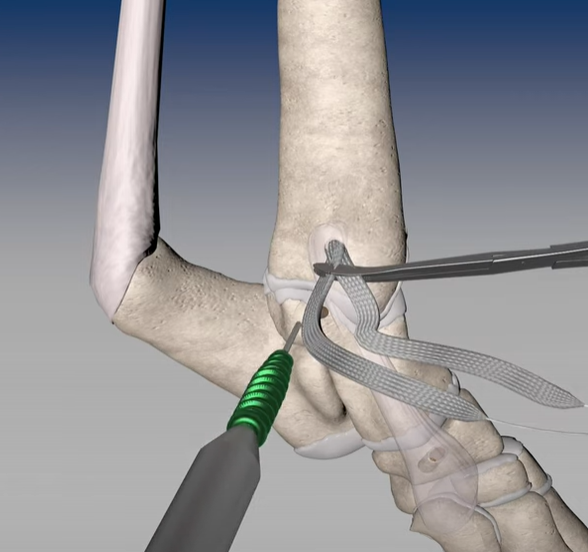 Interference Screws - Novetech Surgery
